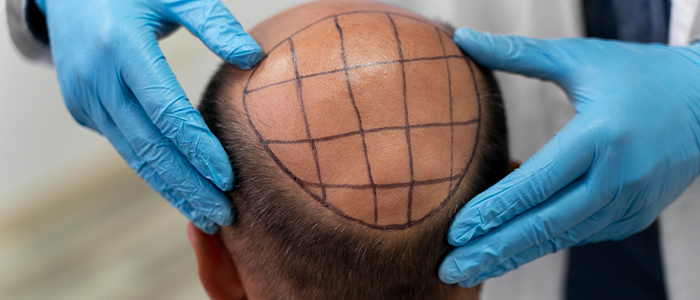 Understanding Hair Fall Causes: Effective Home Remedies Revealed