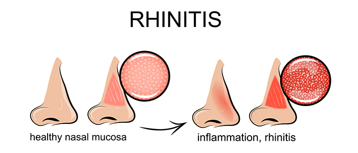 Allergic Rhinitis (Hay Fever) Overview and Home Remedies