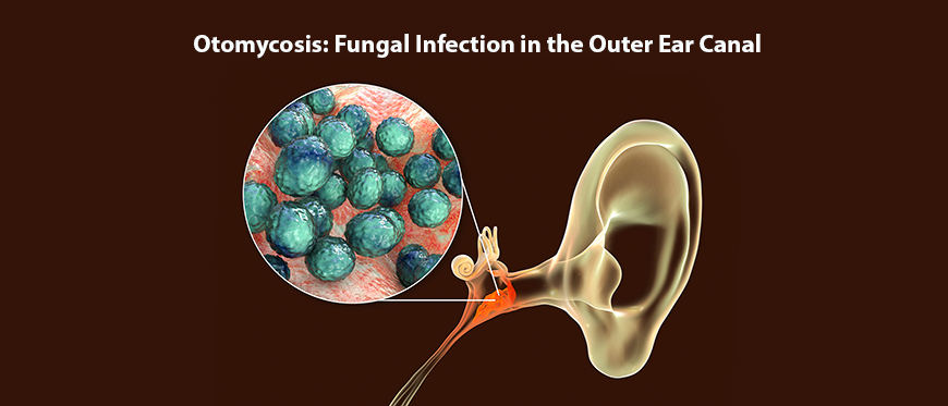 Otomycosis Defination Causes Symptoms And Treatment Truemeds